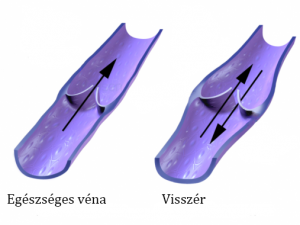 Visszér tágulat - Visszeresség - Visszér kezelés